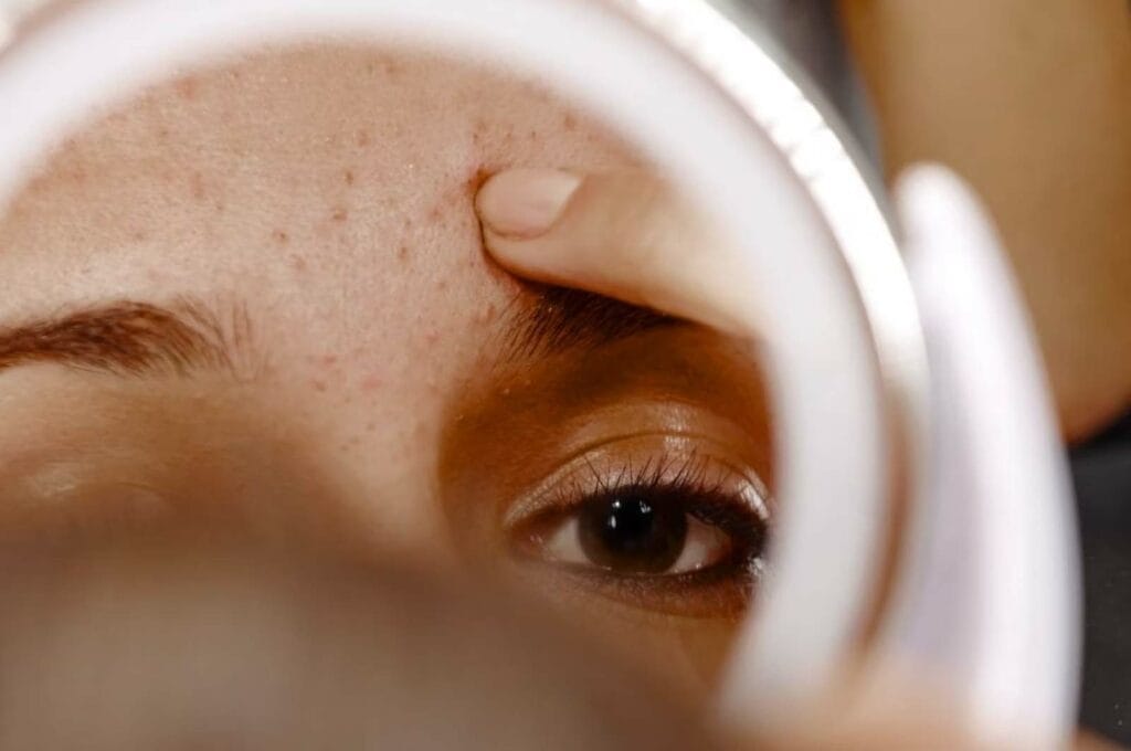 Your ultimate guide to acne, from the types and causes to the best ...